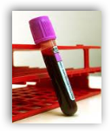 A+PSA New Test For Prostate Cancer Is More Specific and Reduces False ...